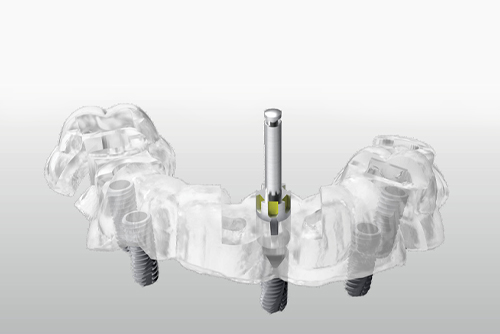 Guided Implant Surgery