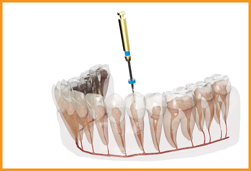 Root Canal Treatment